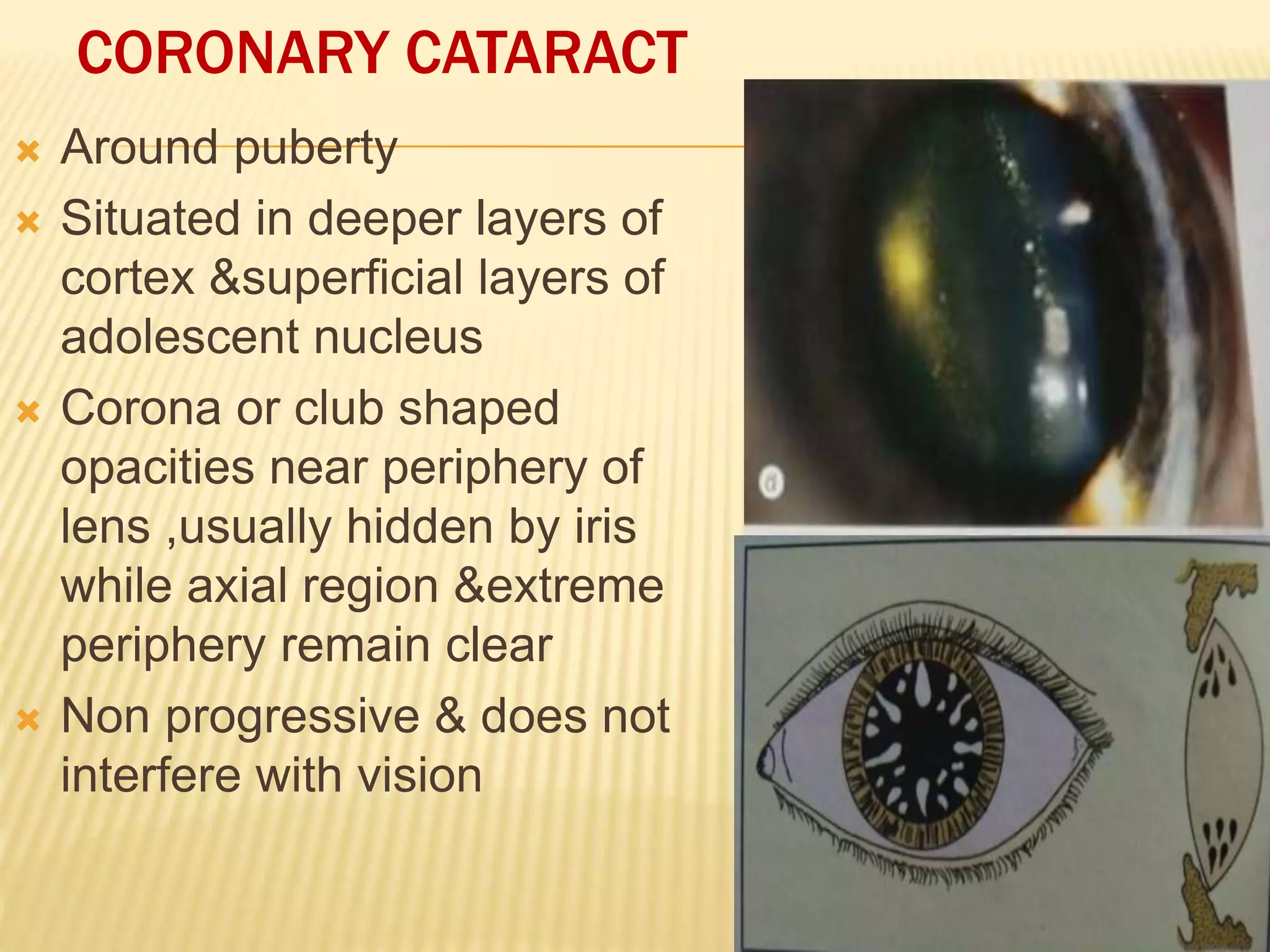 Pediatric cataract | PPTX