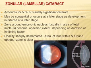 Pediatric cataract | PPTX