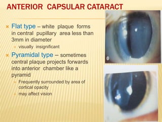Pediatric cataract | PPTX