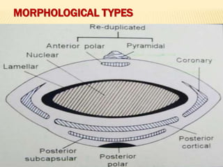 Pediatric cataract | PPTX