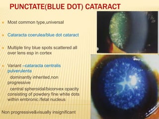 Blue Dot Cataract