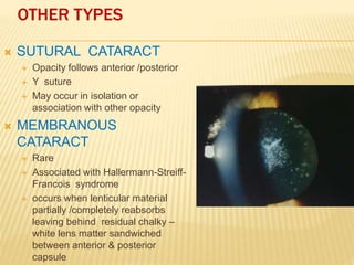Sutural Cataract