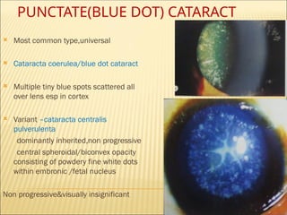 pediatric cataract-causes for not having vision | PPT