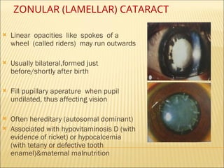 pediatric cataract-causes for not having vision | PPT