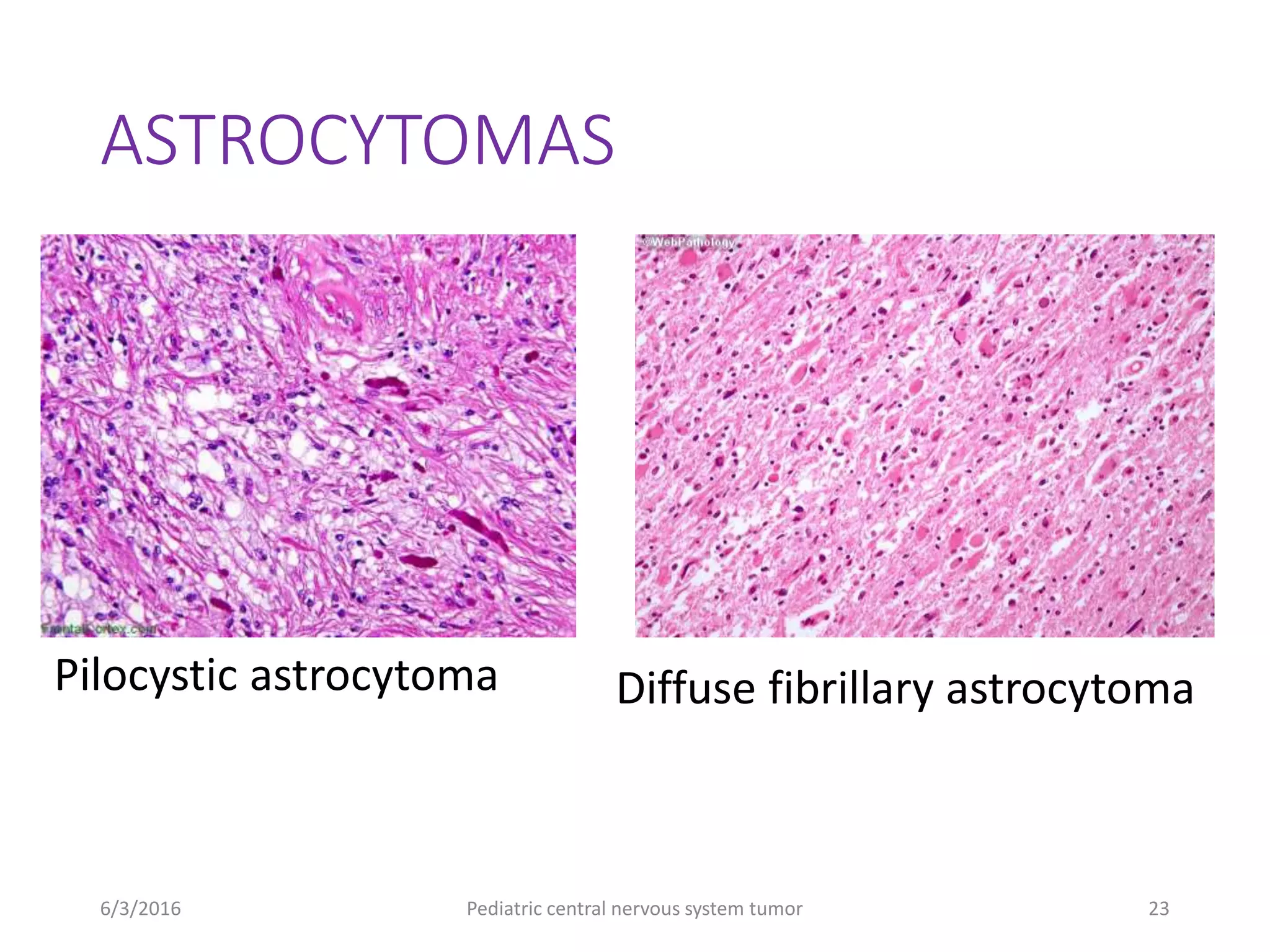 Pediatric cental nervous system tumors | PPTX