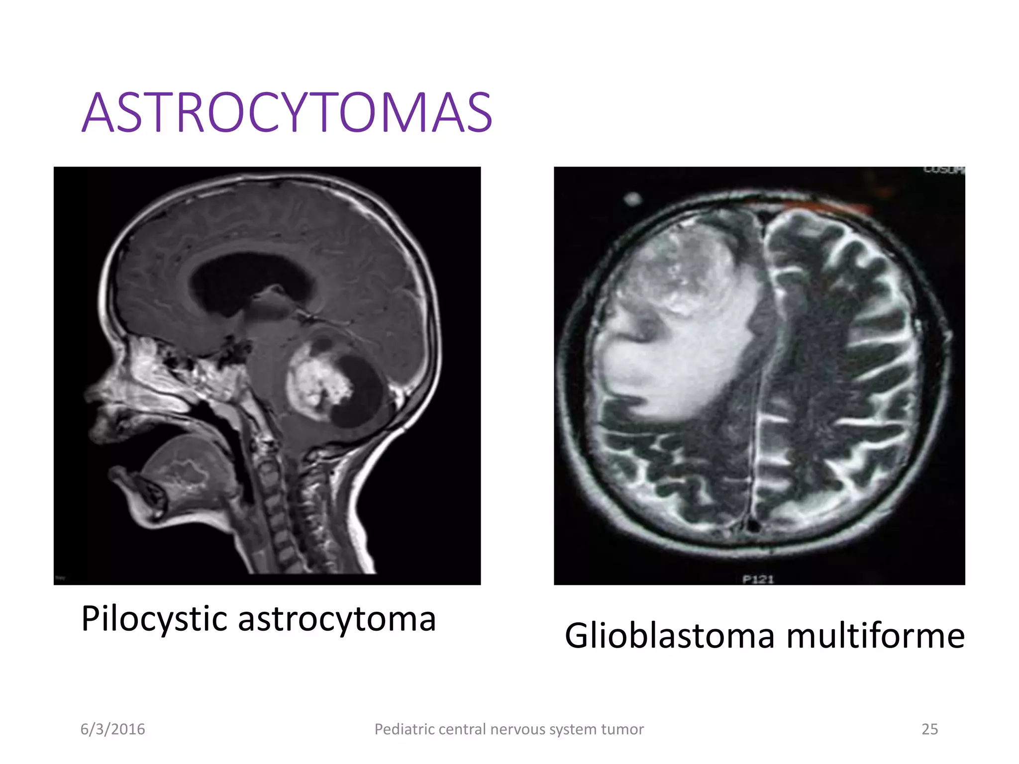 Pediatric cental nervous system tumors | PPTX