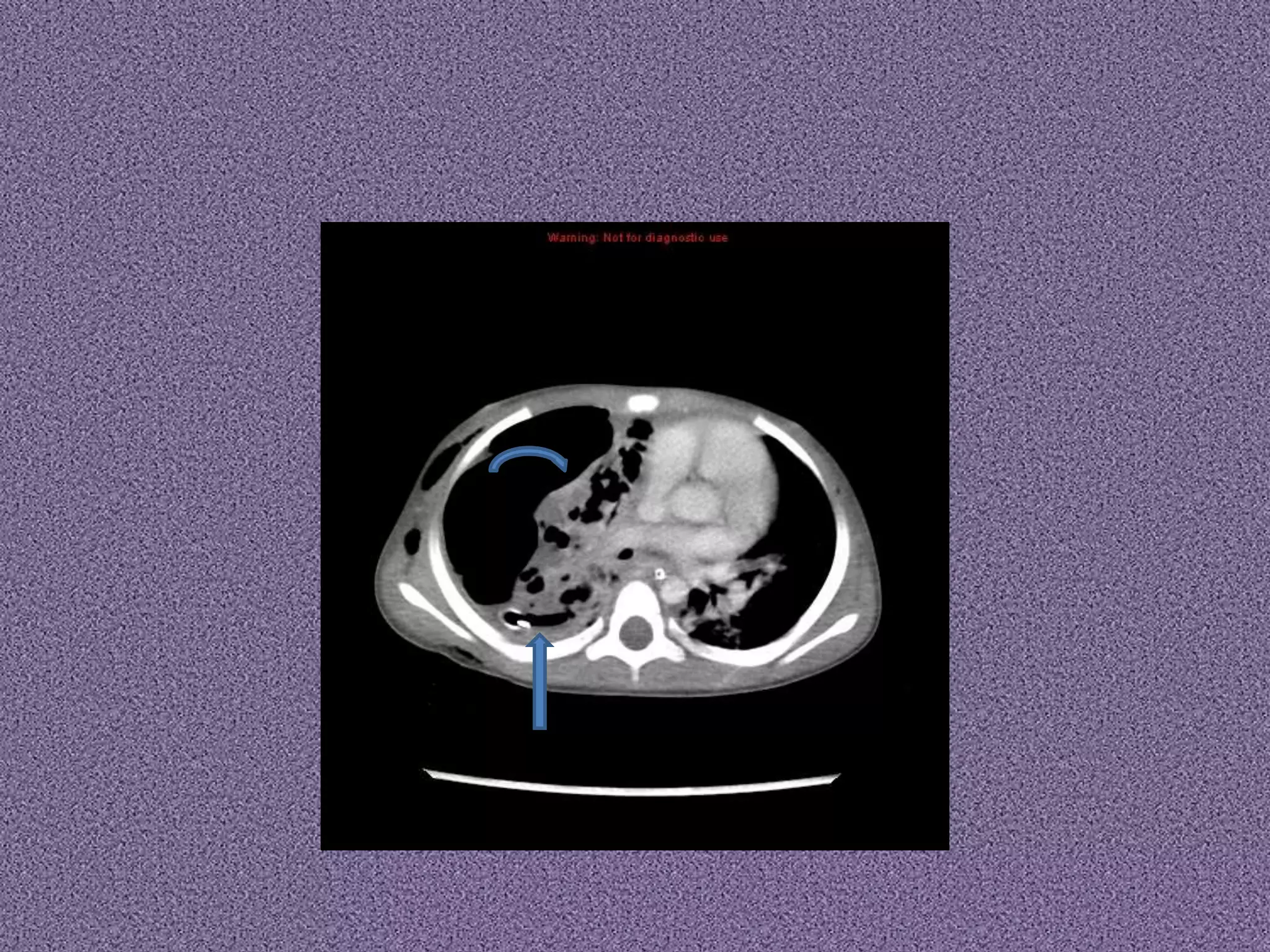 Pediatric chest infection imaging considerations | PPTX