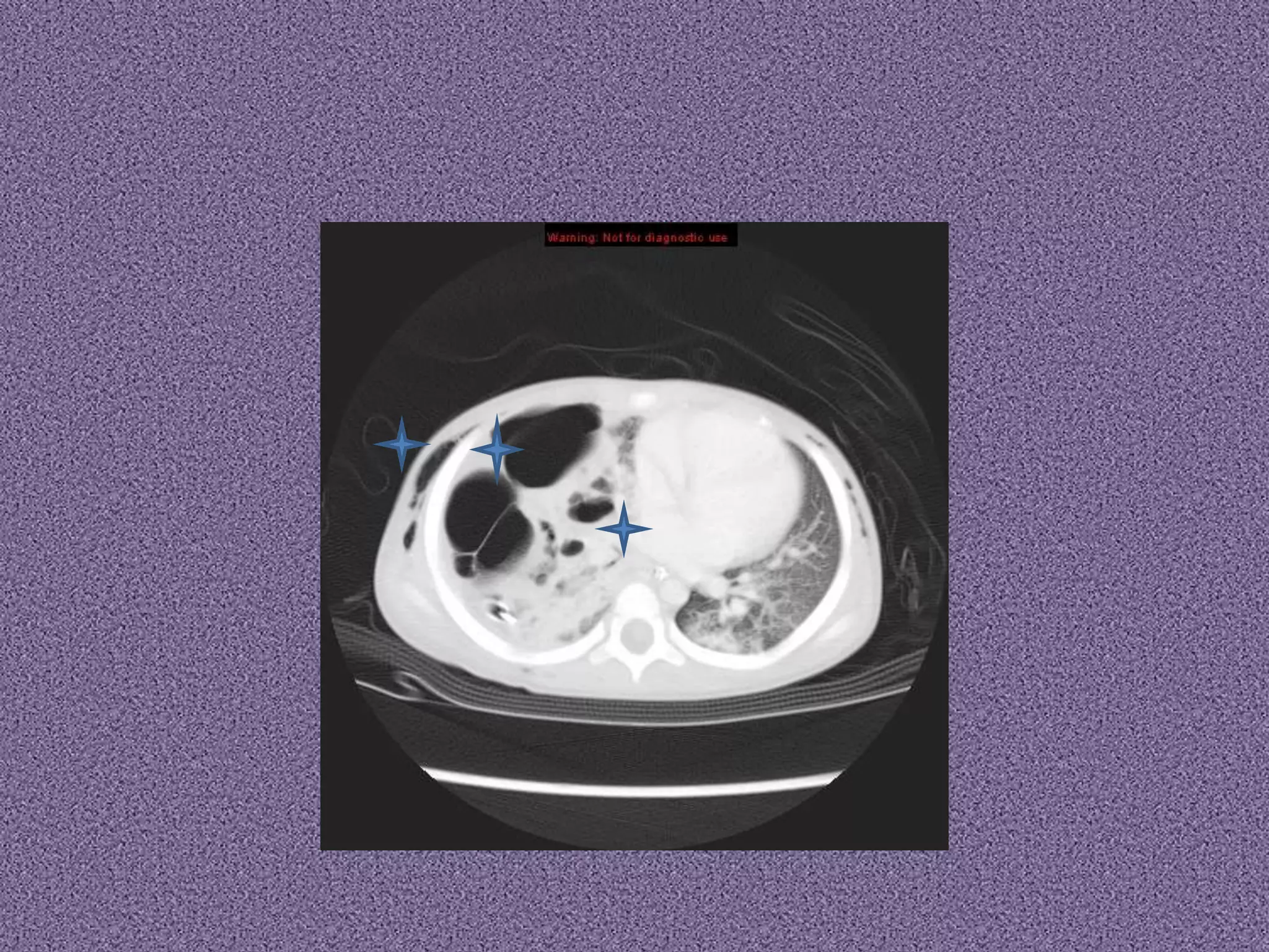 Pediatric chest infection imaging considerations | PPTX