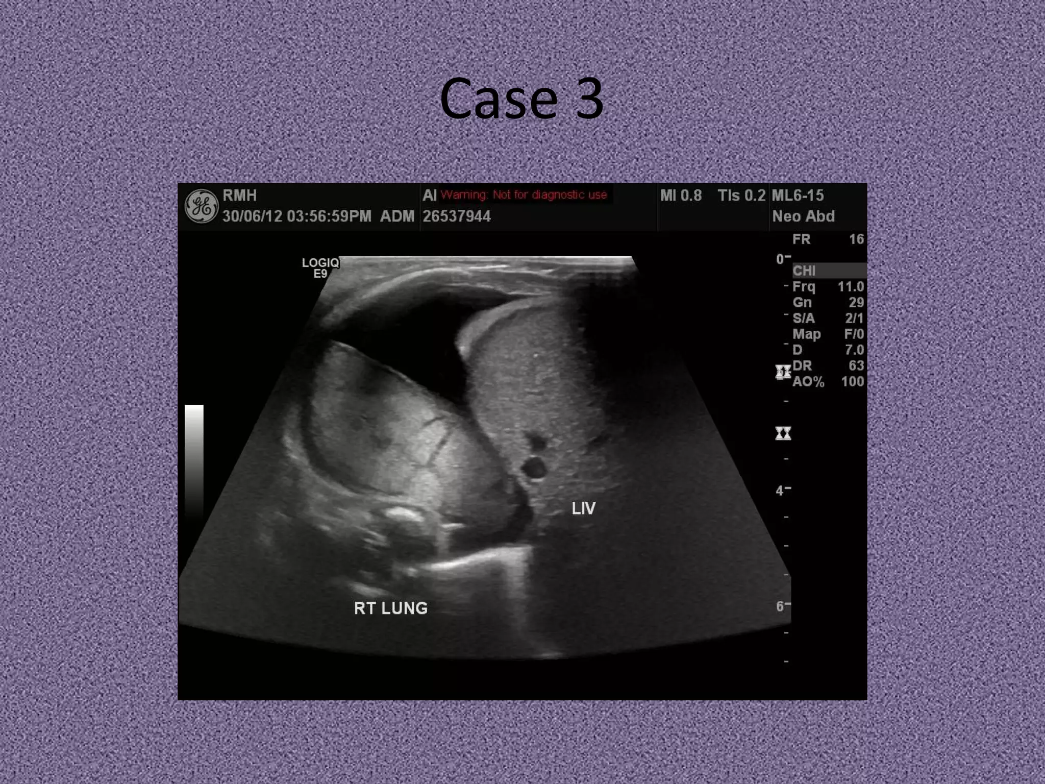 Pediatric chest infection imaging considerations | PPTX
