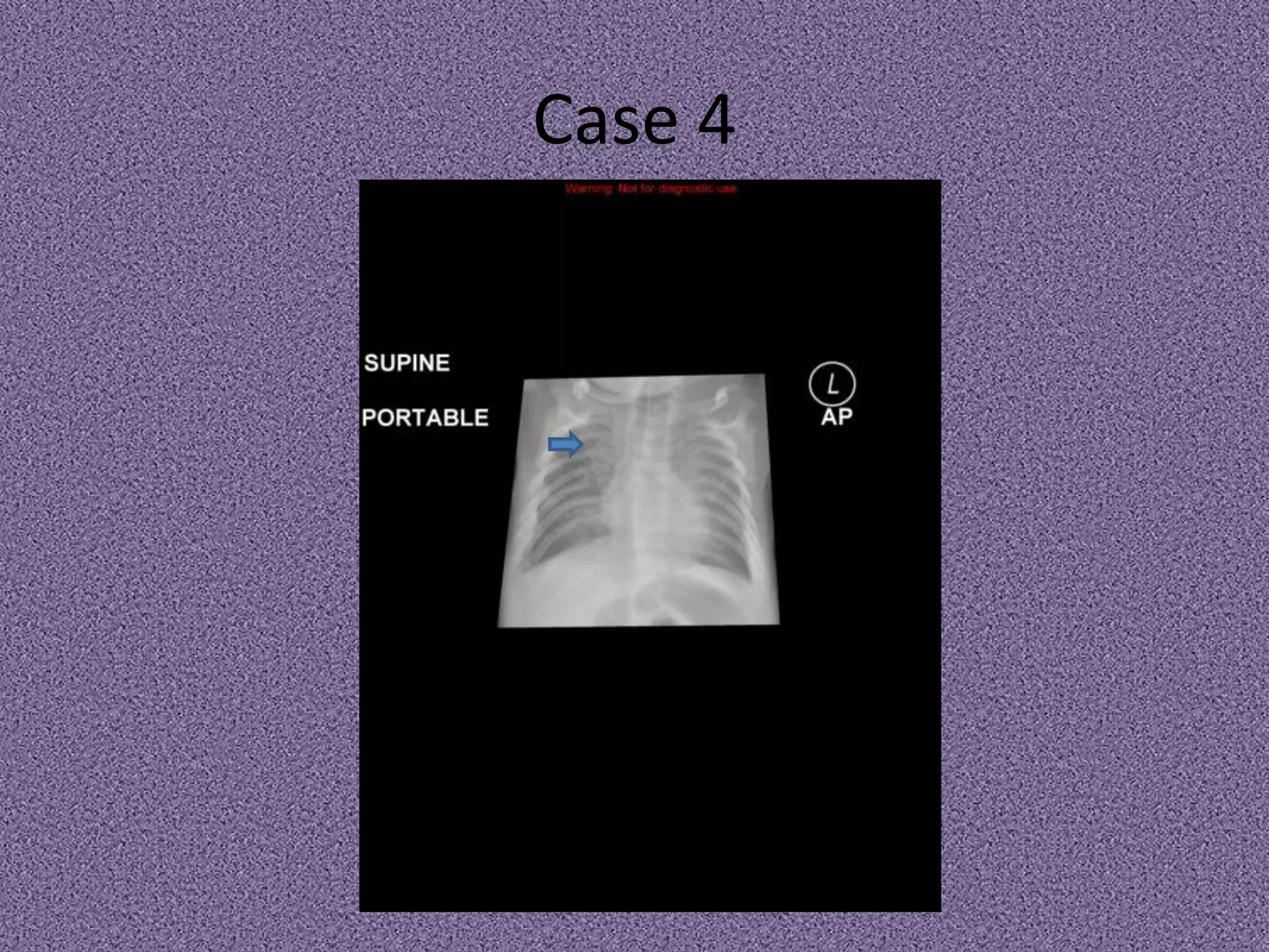 Pediatric chest infection imaging considerations | PPTX