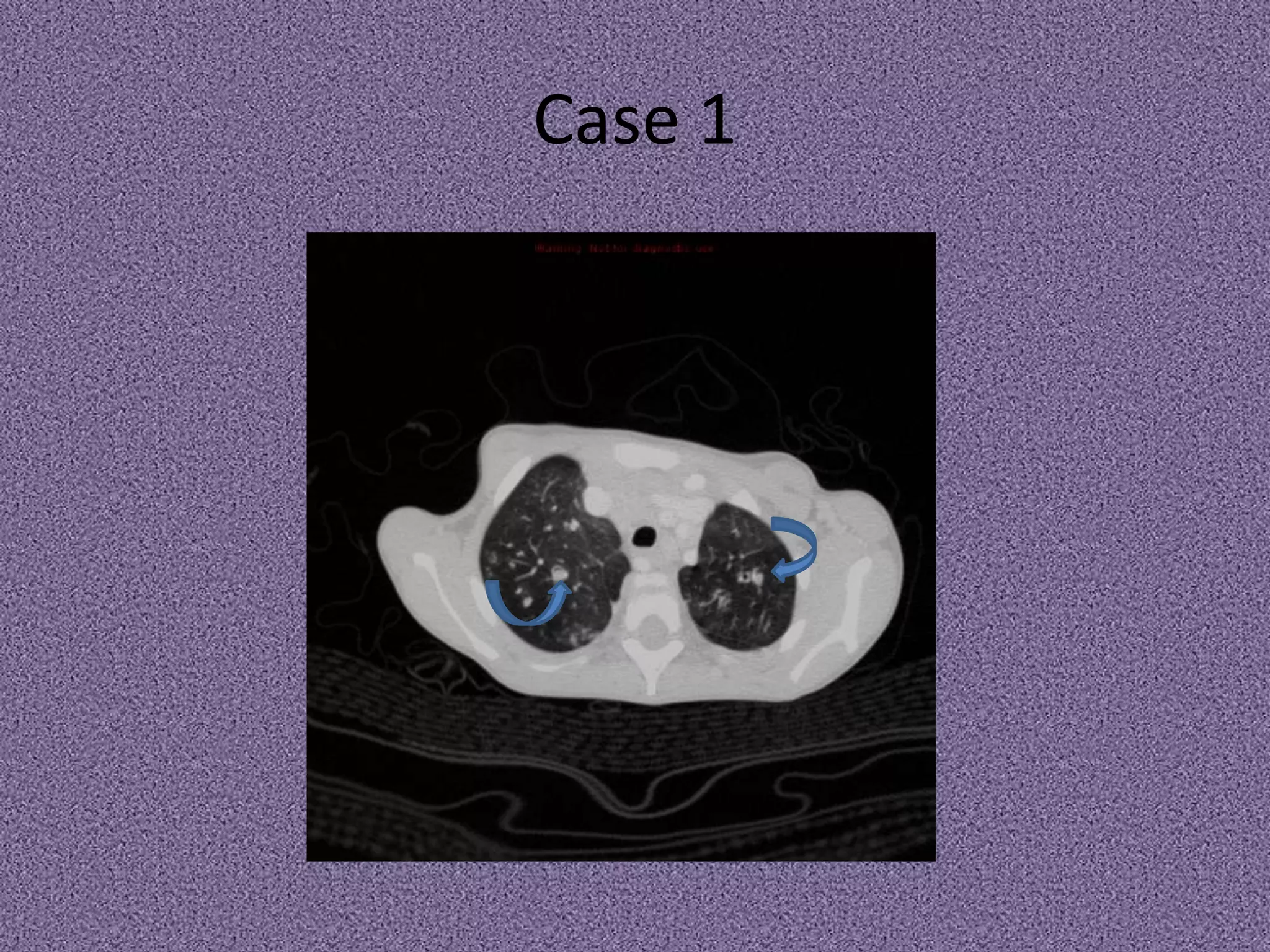 Pediatric chest infection imaging considerations | PPTX