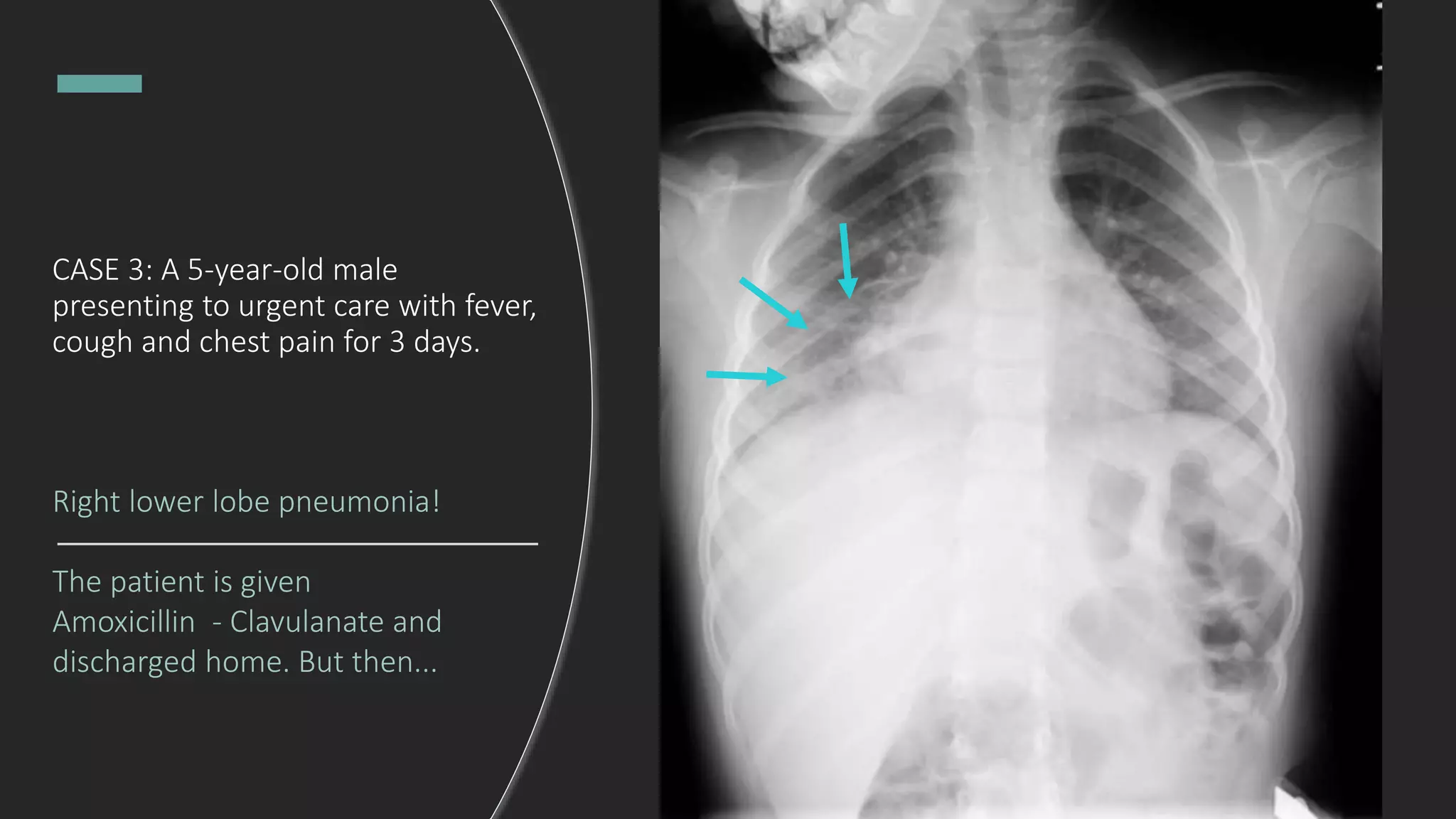 CMC Pediatric X-Ray Mastery: January Cases | PPTX | Lung and ...