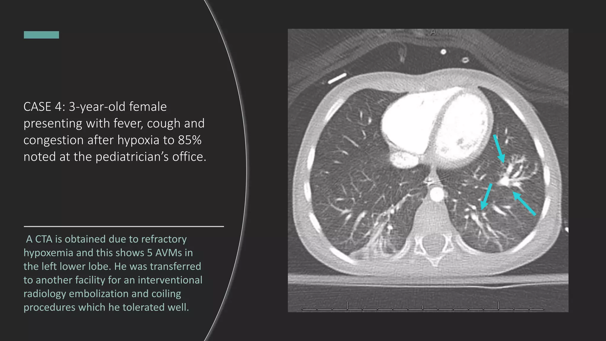 CMC Pediatric X-Ray Mastery: January Cases | PPTX | Lung and ...