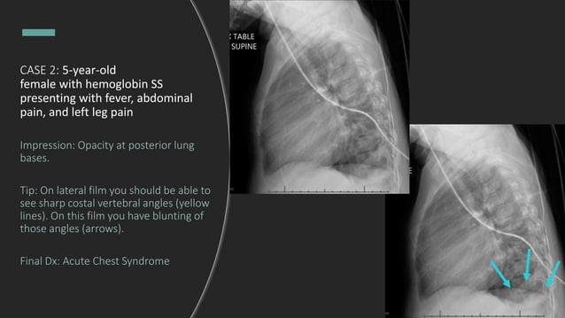 CMC Pediatric X-Ray Mastery: January Cases | PPTX | Lung and ...