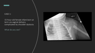 Shoulder Dystocia Xray