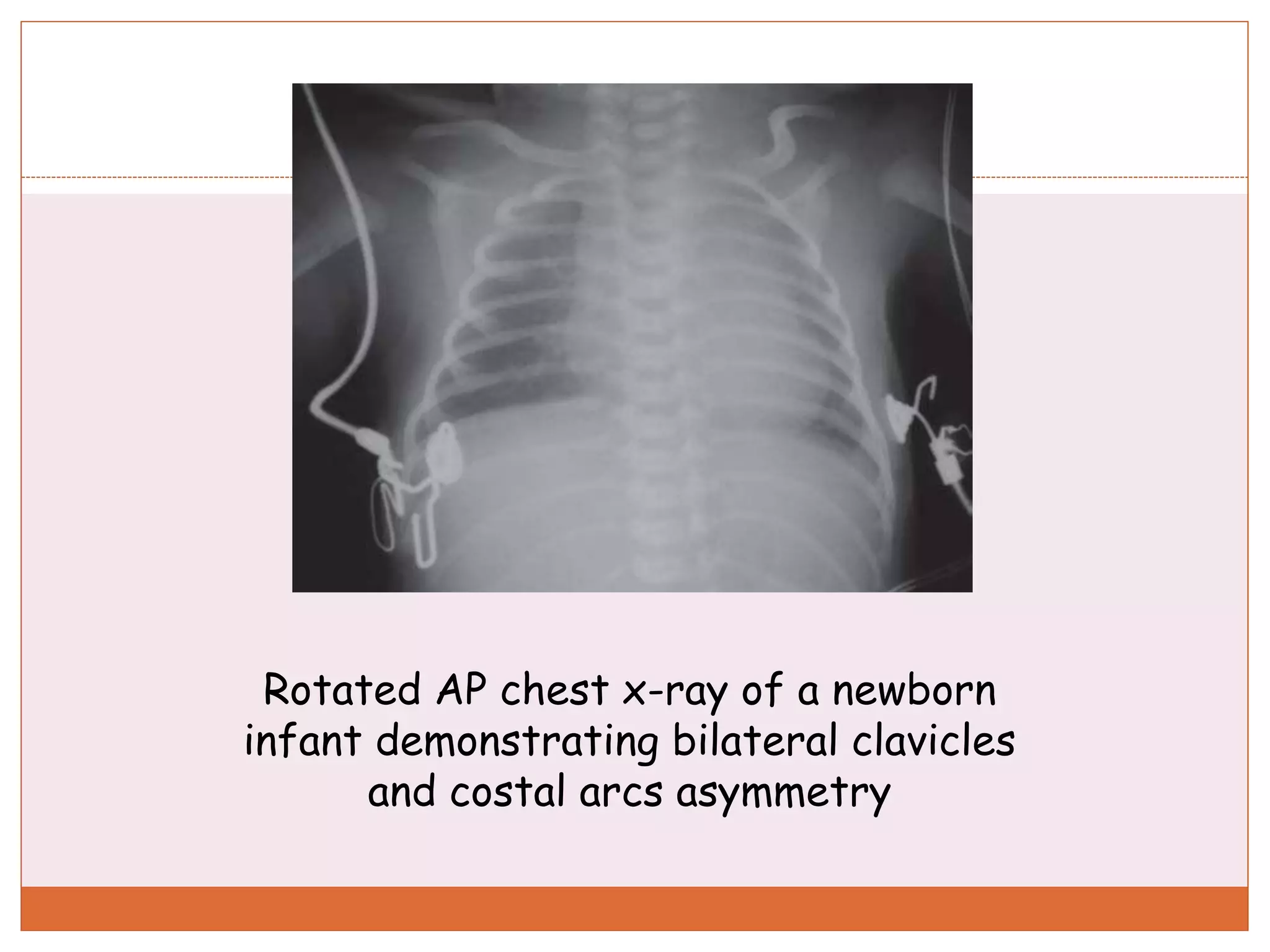 Pediatric chest xray | PPT