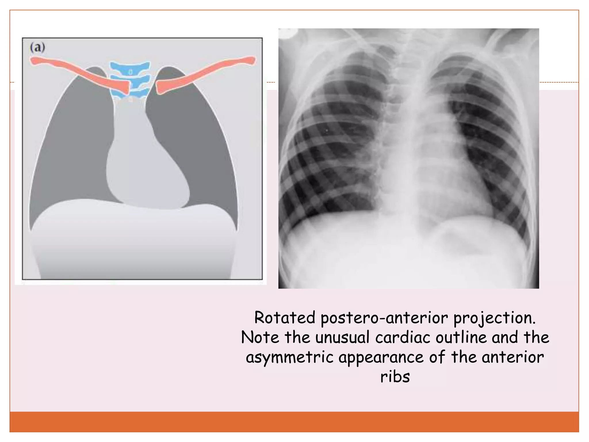 Pediatric chest xray | PPT