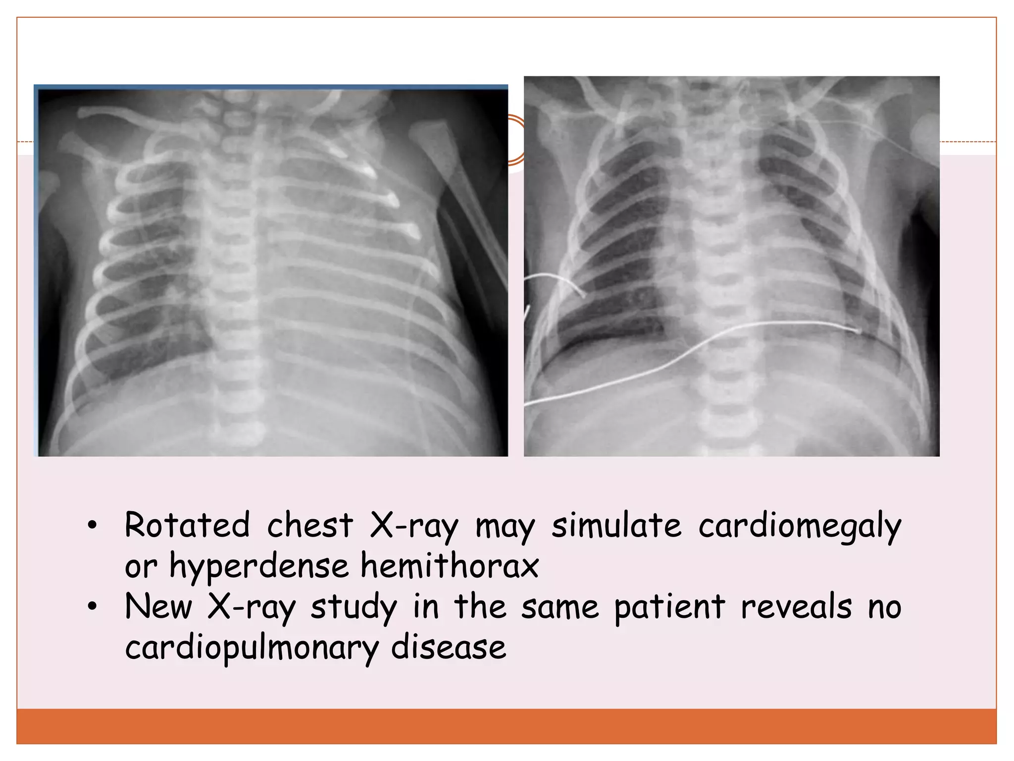 Pediatric chest xray | PPT