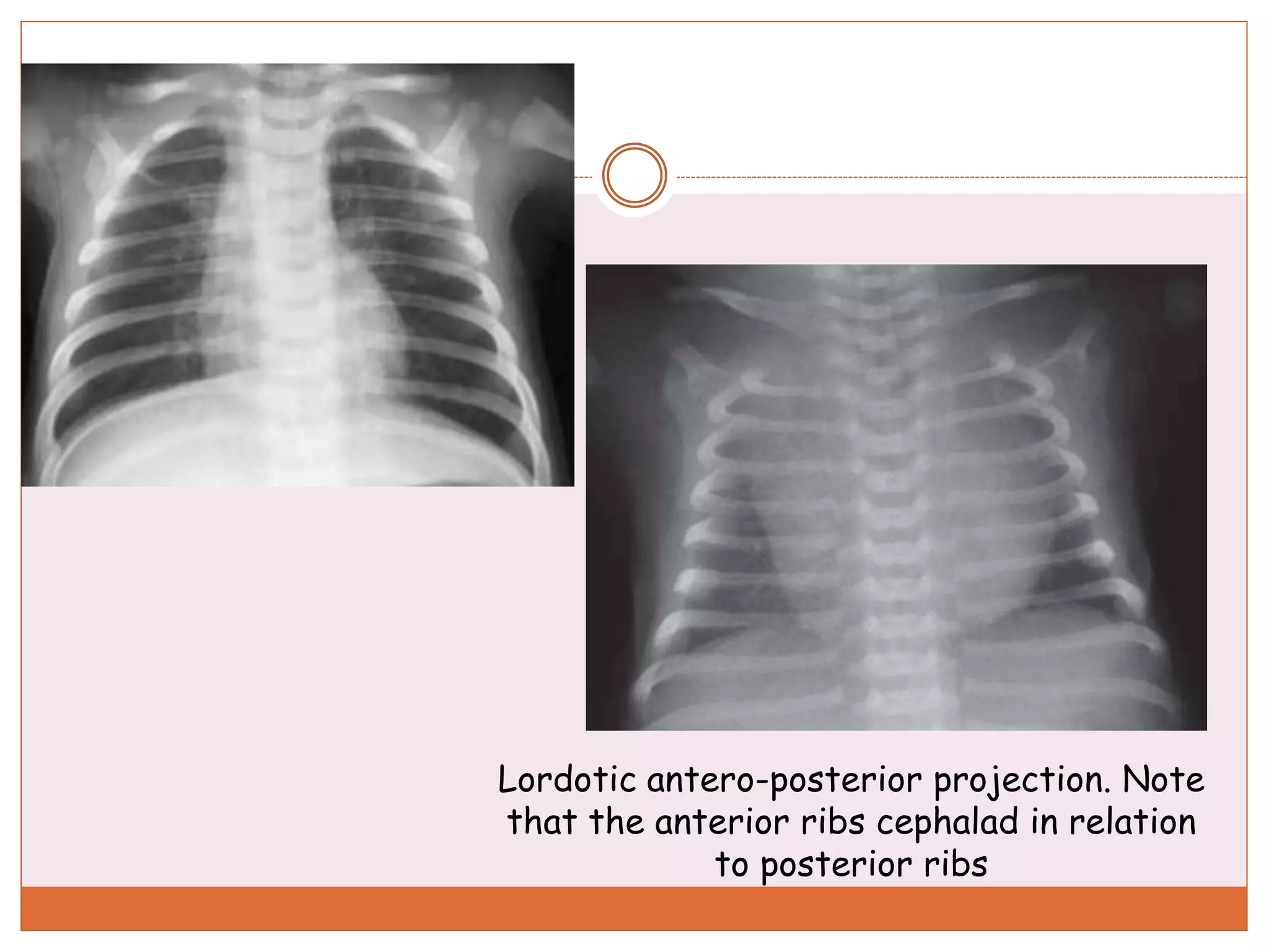 Pediatric chest xray | PPT