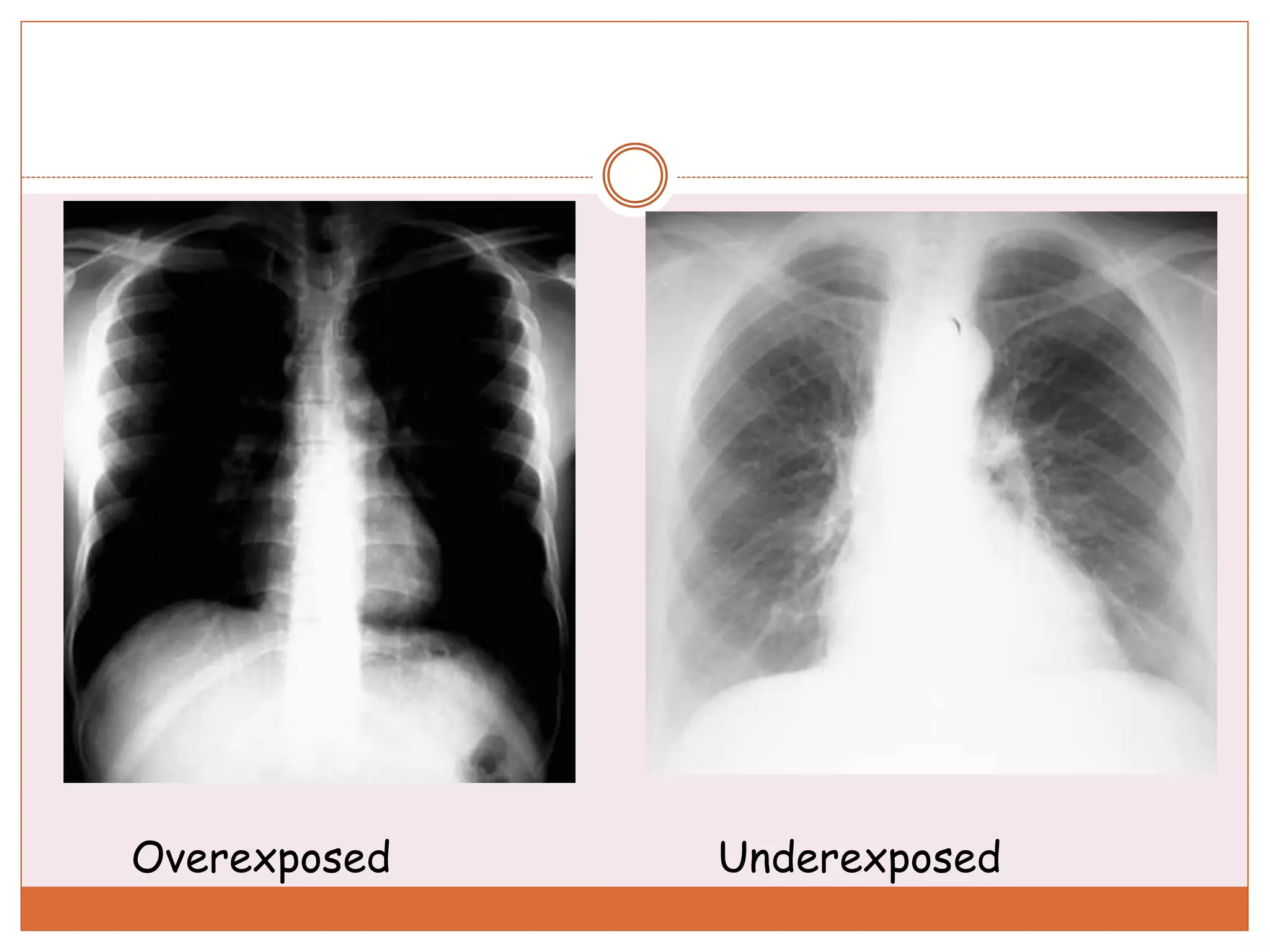 Pediatric chest xray | PPT