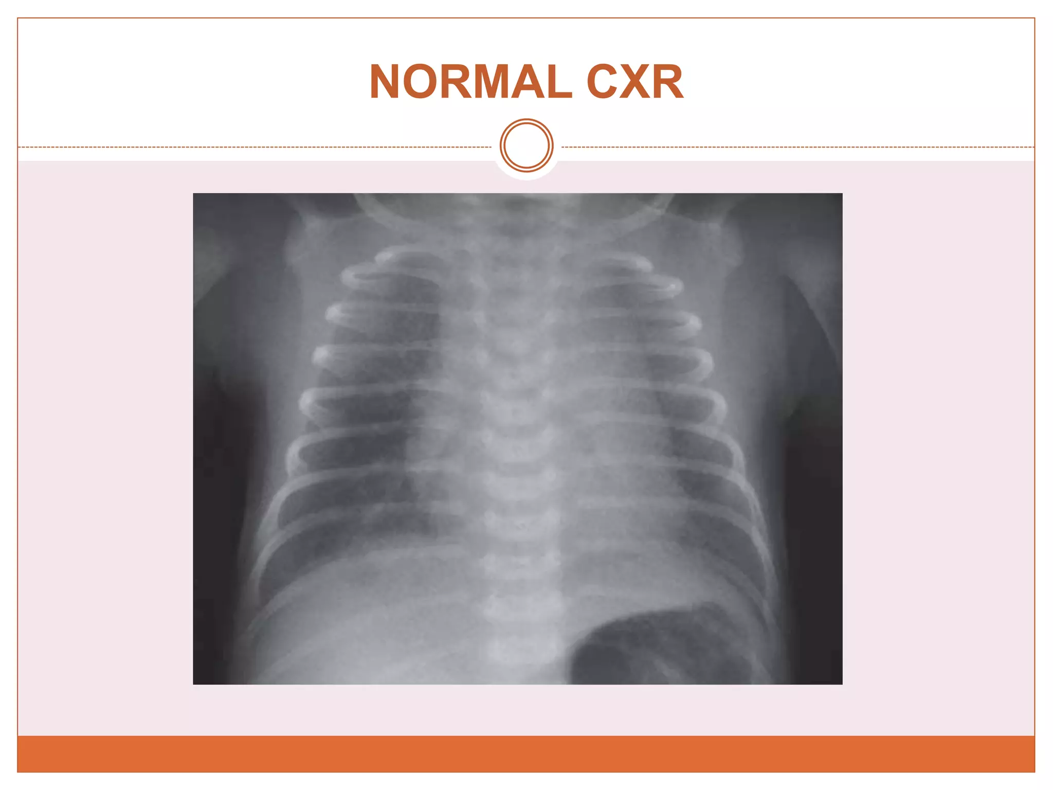 Pediatric chest xray | PPT