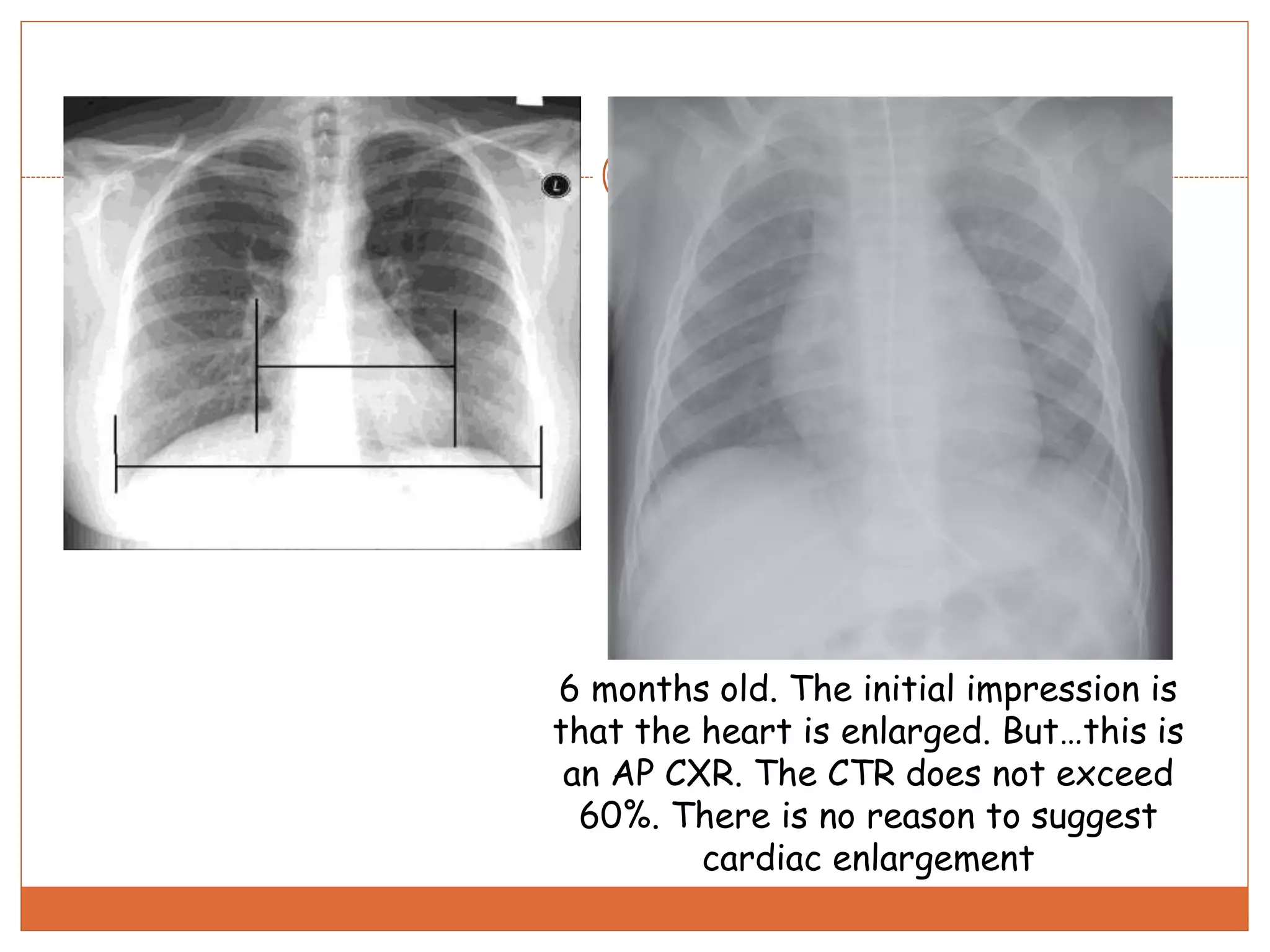Pediatric chest xray | PPT
