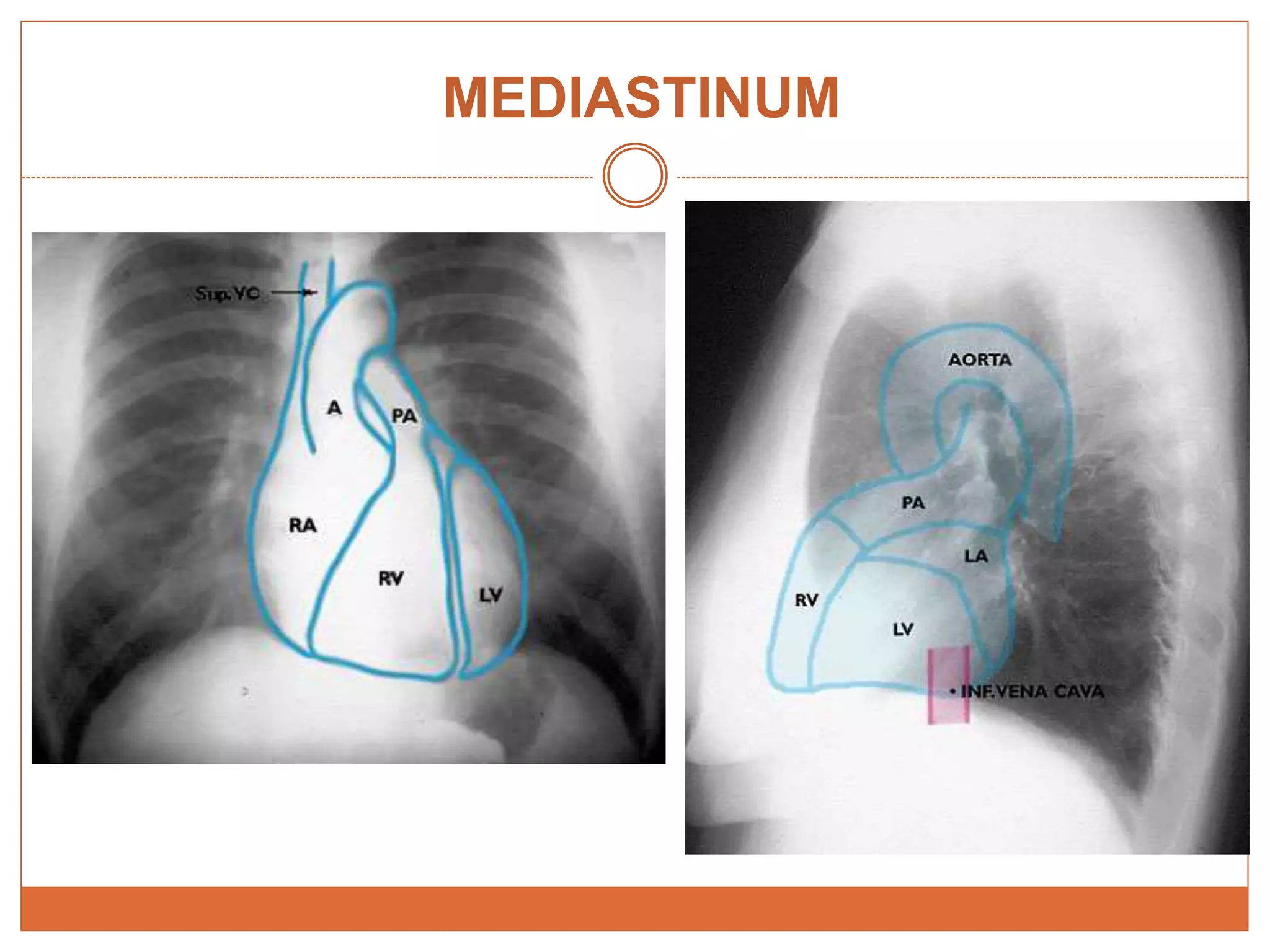 Pediatric chest xray | PPT