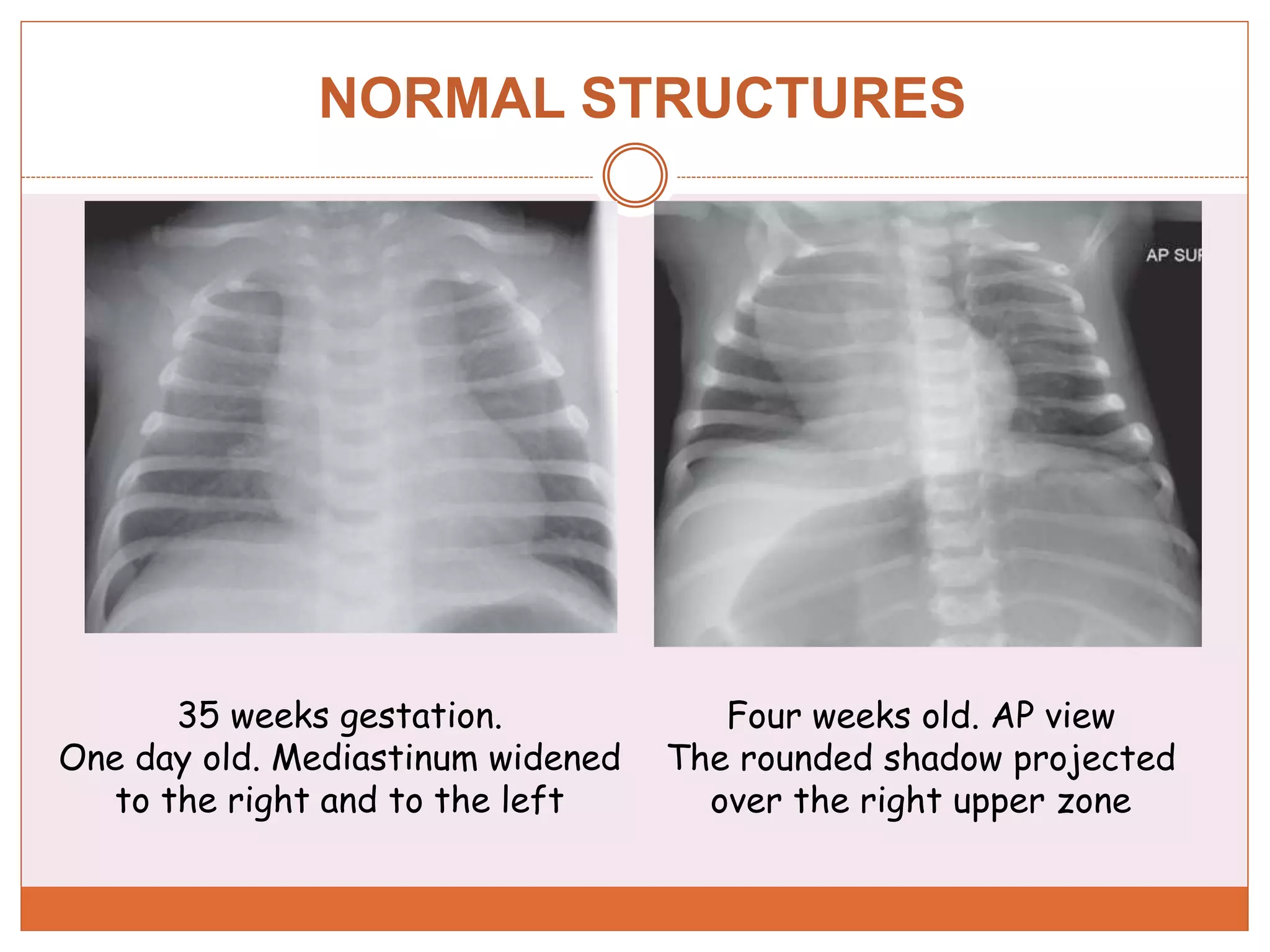 Pediatric chest xray | PPT