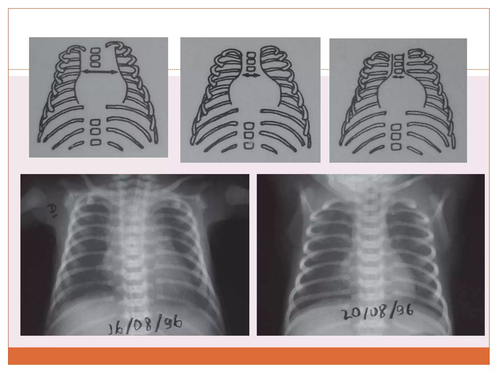 Pediatric chest xray | PPT
