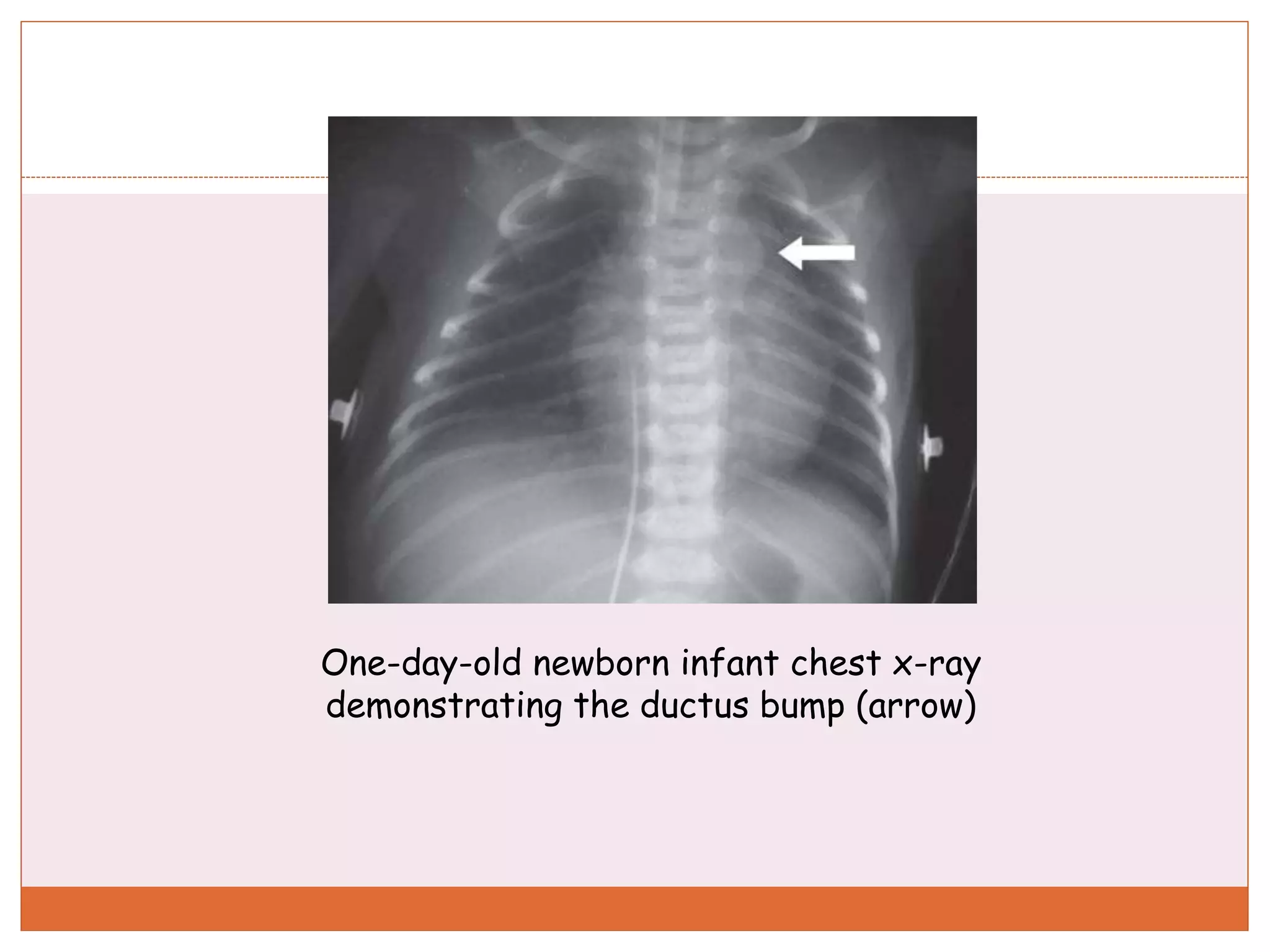 Pediatric chest xray | PPT