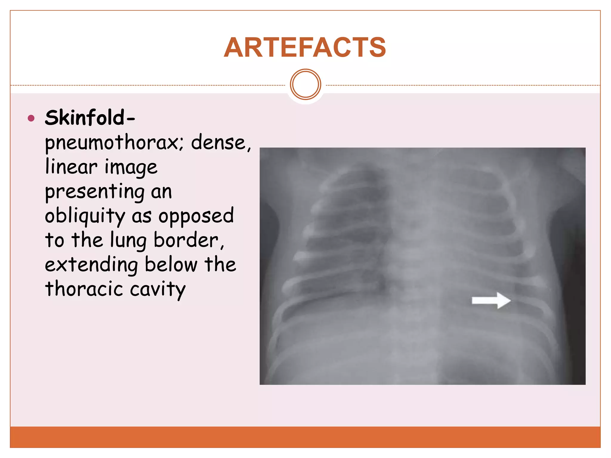 Pediatric chest xray | PPT