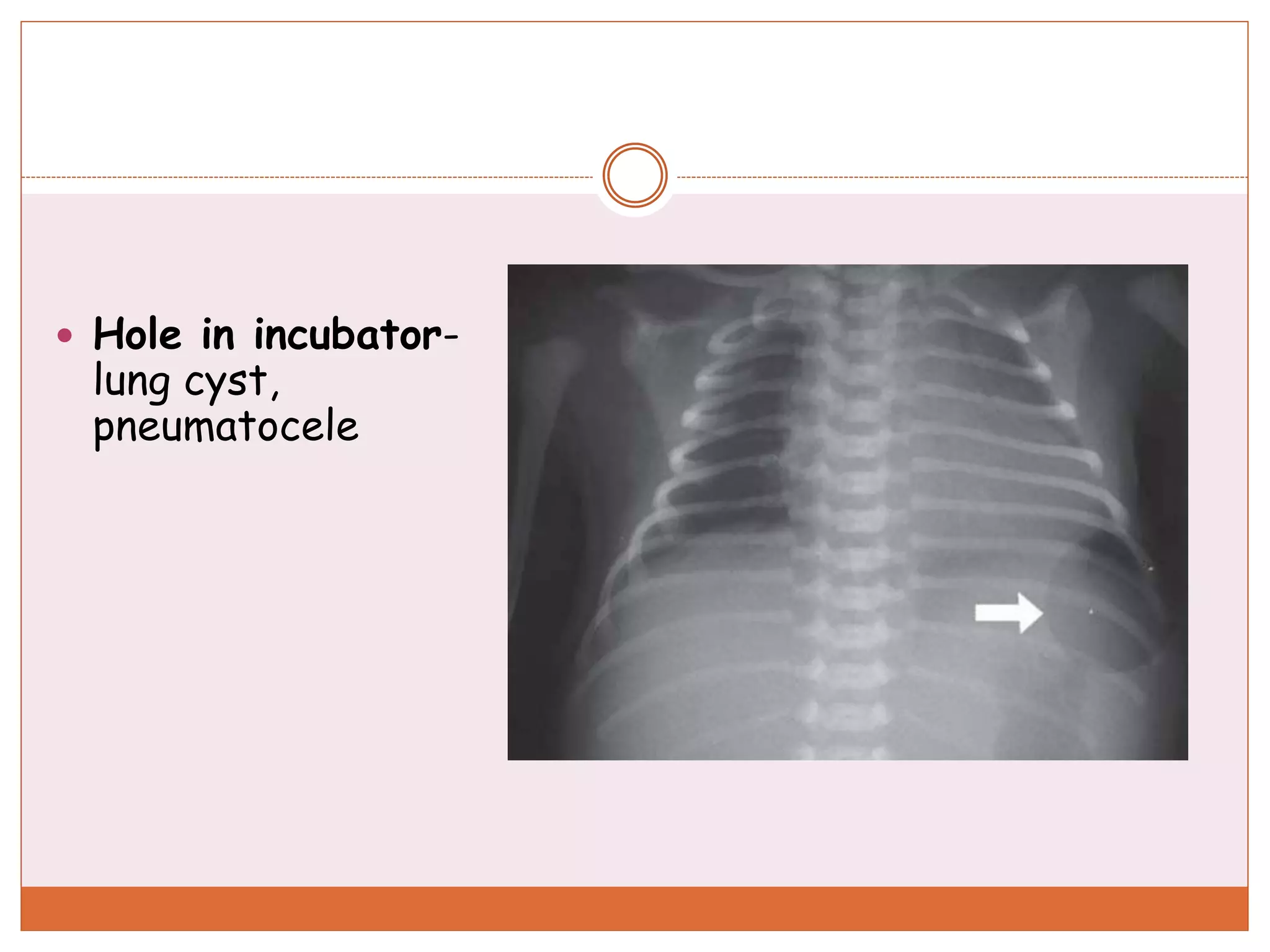 Pediatric chest xray | PPT