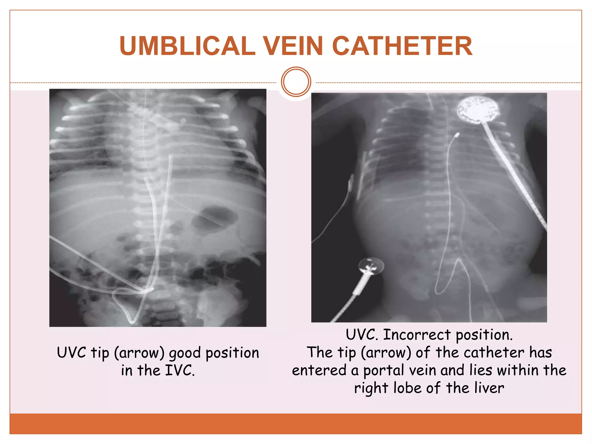 Pediatric chest xray | PPT