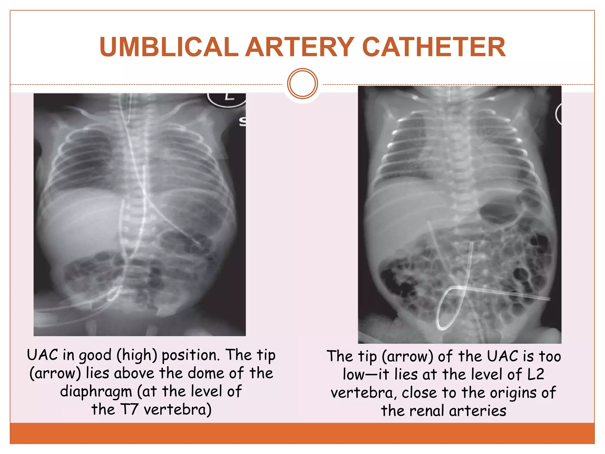 Pediatric chest xray | PPT