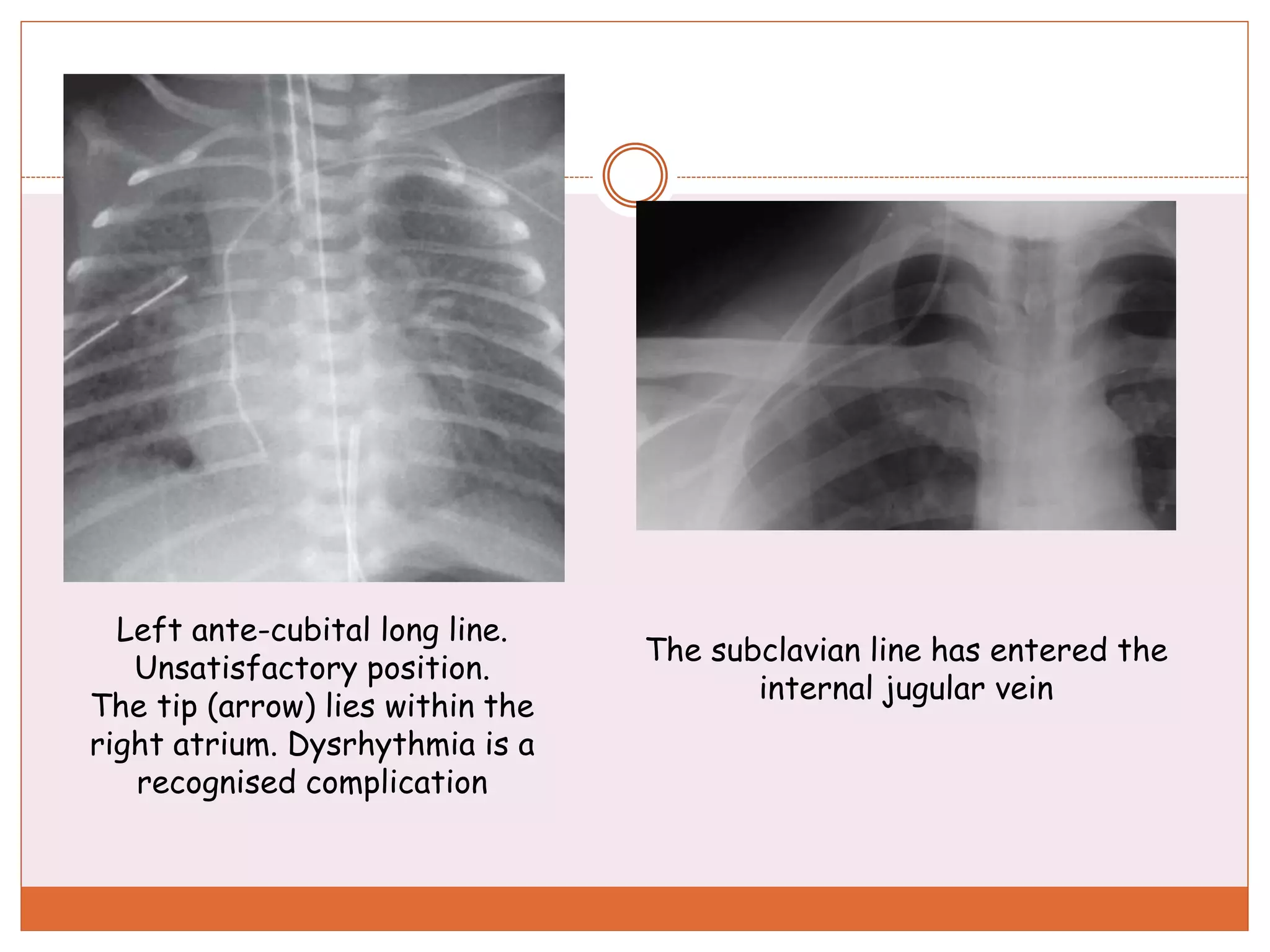 Pediatric Chest Xray Ppt
