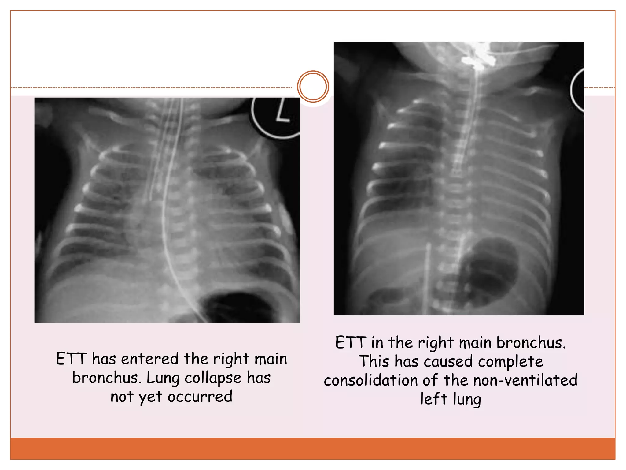 Pediatric chest xray | PPT