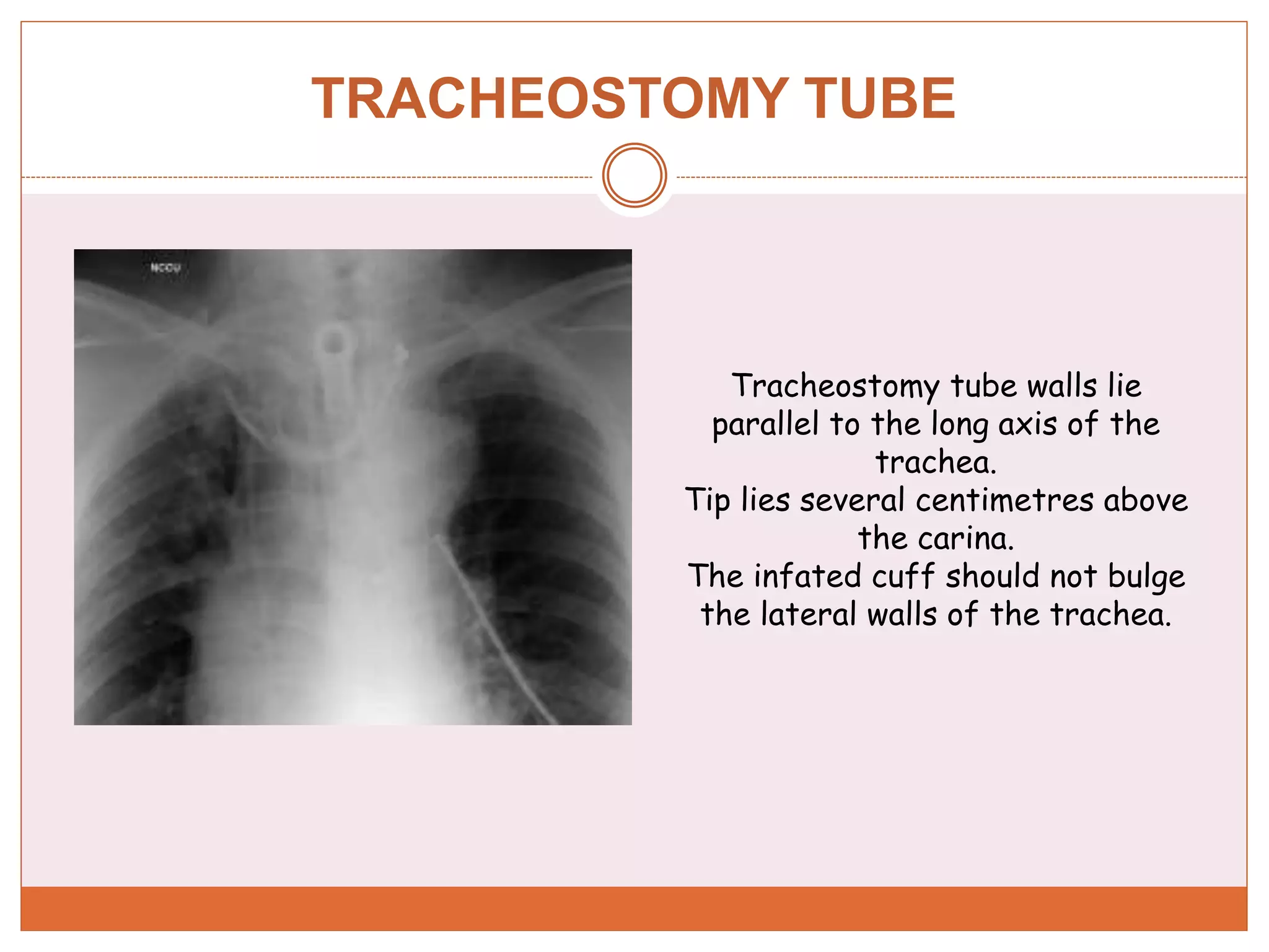 Pediatric chest xray | PPT