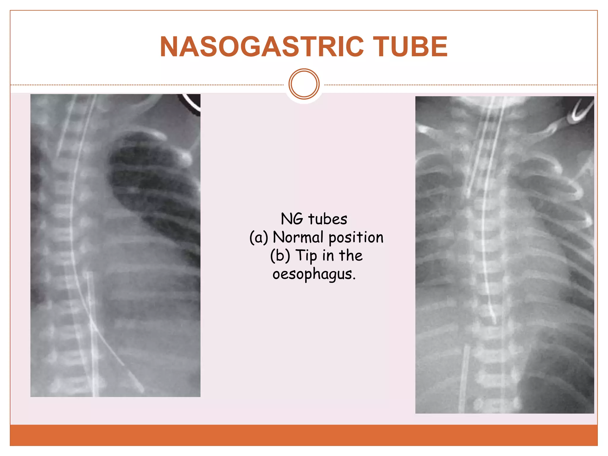 Pediatric chest xray | PPT