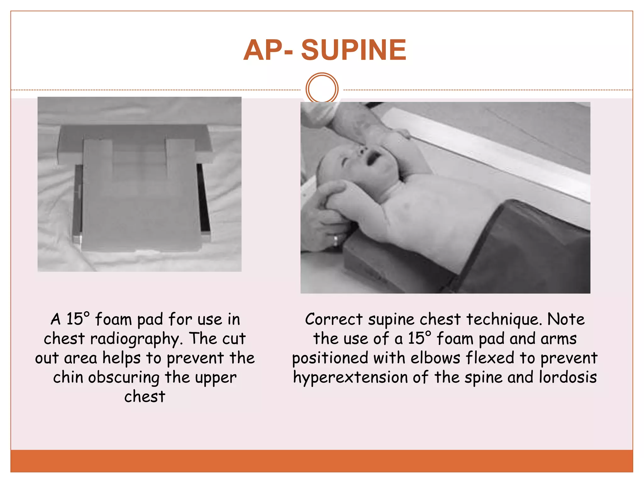 Pediatric chest xray | PPT