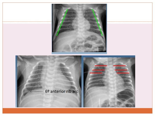 Pediatric chest xray | PPT | Lung and Respiratory Health | Diseases and ...