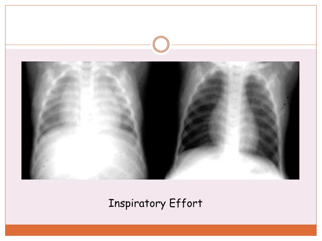 Pediatric chest xray | PPT | Lung and Respiratory Health | Diseases and ...