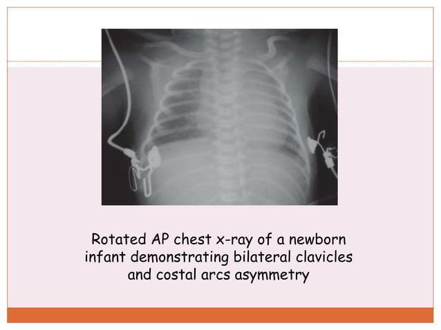 Pediatric chest xray | PPT | Lung and Respiratory Health | Diseases and ...