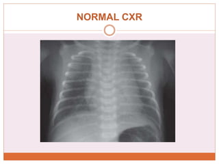 Pediatric chest xray | PPT