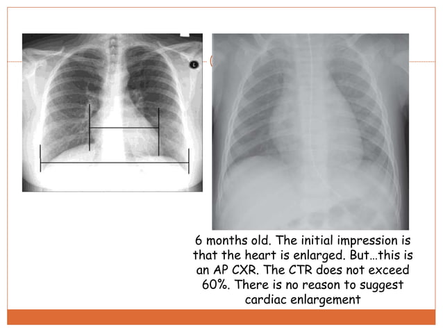 Pediatric chest xray | PPT | Lung and Respiratory Health | Diseases and ...