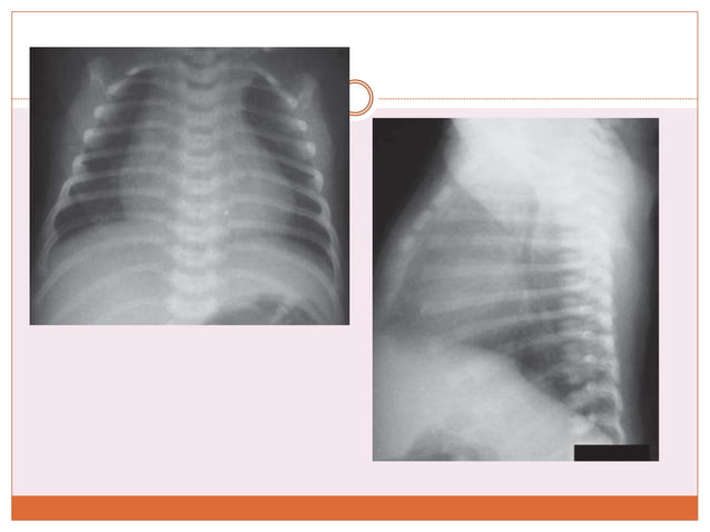 Pediatric chest xray | PPT | Lung and Respiratory Health | Diseases and ...