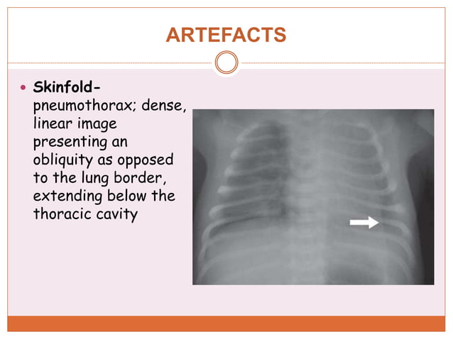 Pediatric chest xray | PPT | Lung and Respiratory Health | Diseases and ...