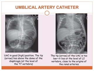 Pediatric chest xray | PPT