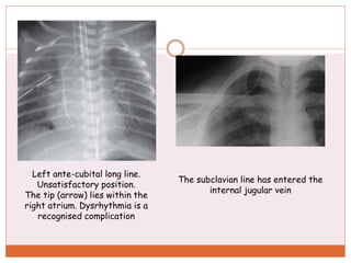 Pediatric chest xray | PPT