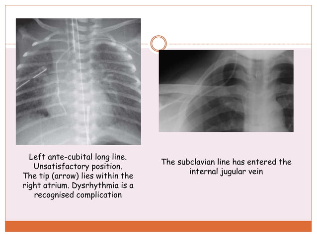 Pediatric chest xray | PPT | Lung and Respiratory Health | Diseases and ...