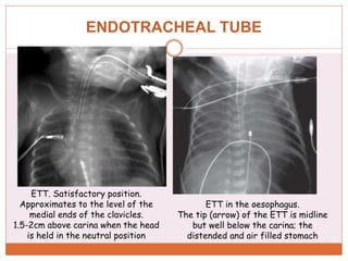 Pediatric chest xray | PPT